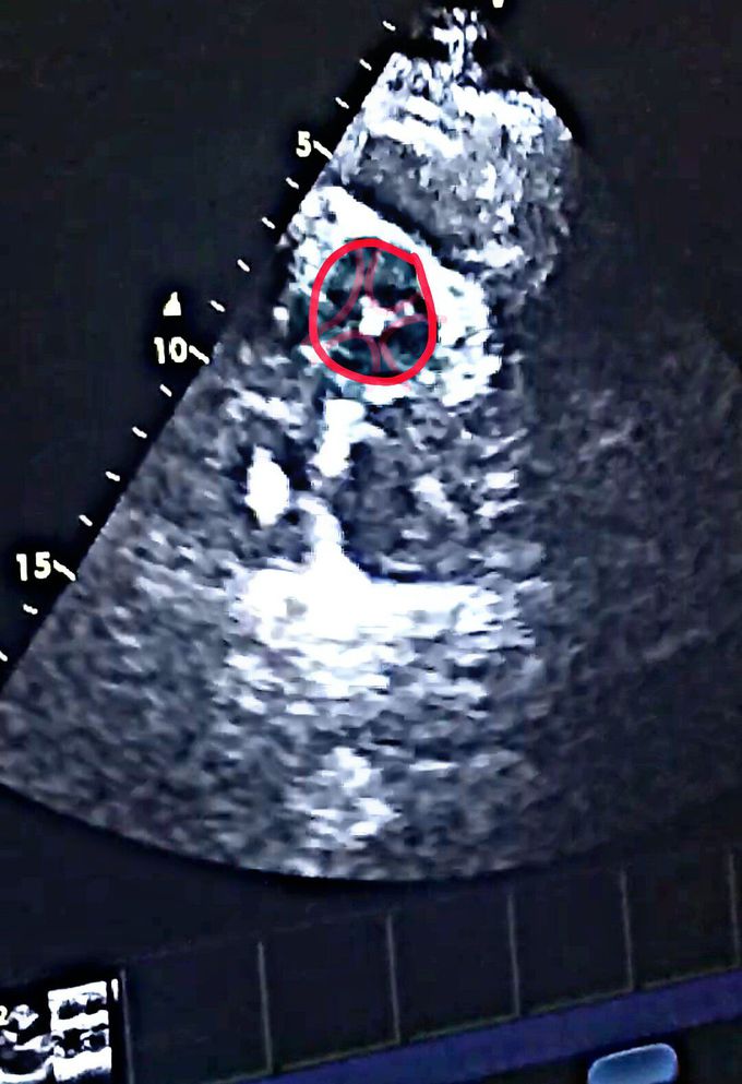QAV (Quadricuspid aortic valve) - MEDizzy
