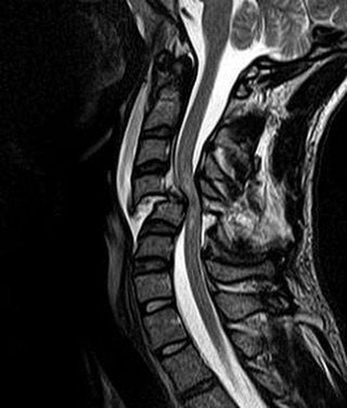 MRI of fractured and dislocated neck vertebra that is - MEDizzy