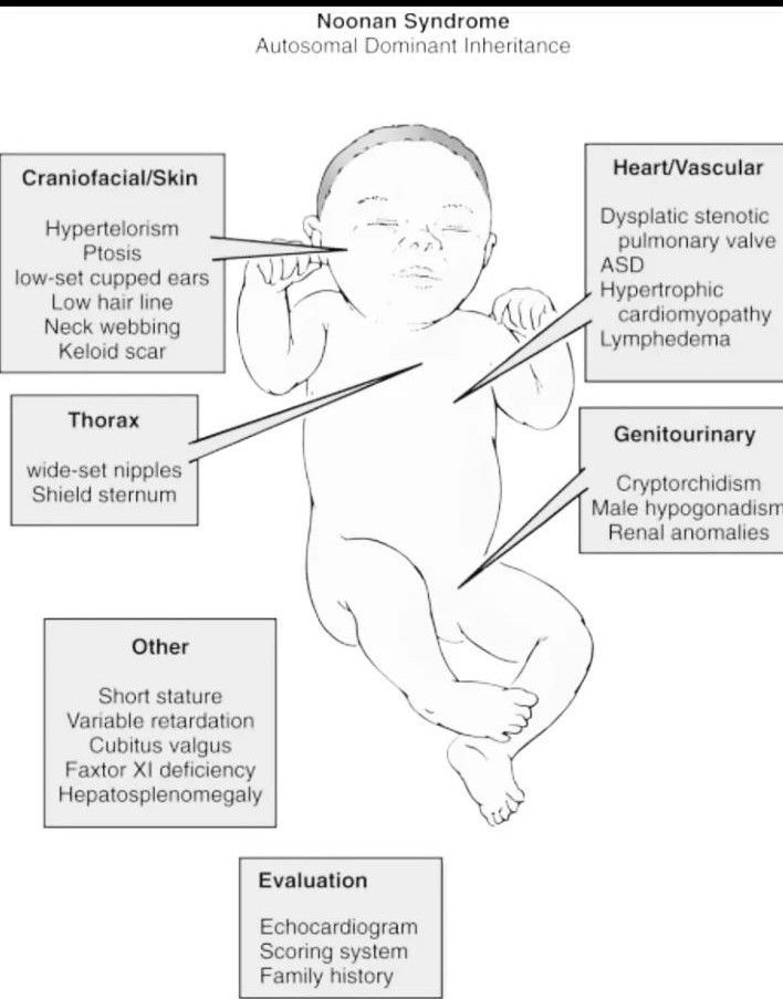 Noonan Syndrome Diagram
