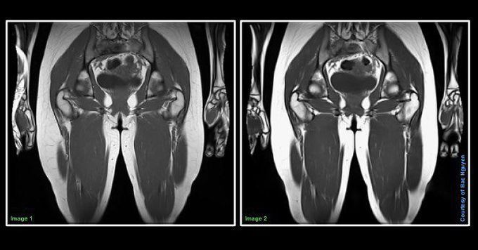MRI “true” t1w BLADE @ Siemens 1.5T Aera BLADE technique is - MEDizzy