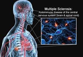 Multiple sclerosis disease - MEDizzy