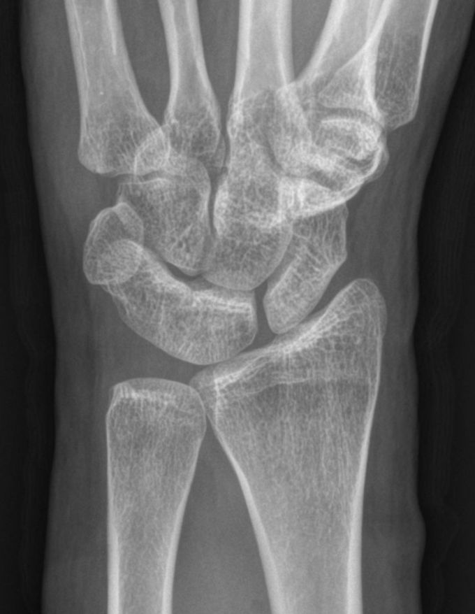 Carpal fusion - MEDizzy