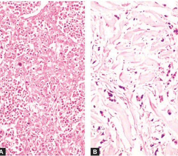 Tumour stroma - MEDizzy
