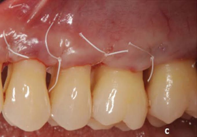 5 stages of healing after periodontal surgery - MEDizzy