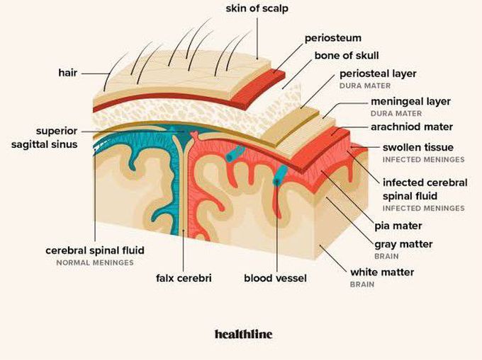Meningitis - MEDizzy