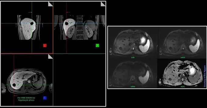 MRI Abdominal Imaging – lipoma @ Siemens 3T Ever wonder why - MEDizzy