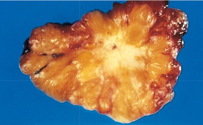 Breast cancer - MEDizzy