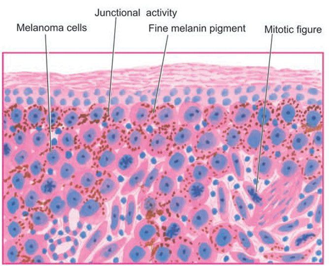 Malignant Melanoma Histology Melanoma Pathology | DermNet NZ