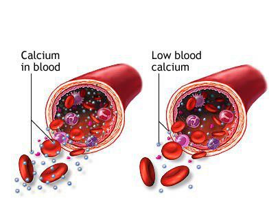 Hypocalcemia - MEDizzy