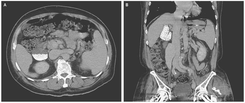 Cholelithiasis - MEDizzy