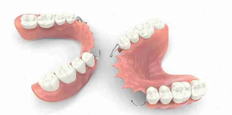 Removable partial denture - MEDizzy