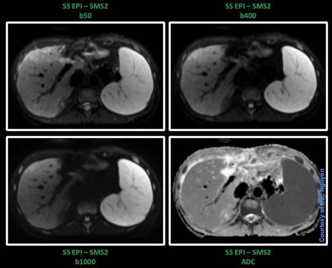 MR Abdominal Imaging - Simultaneous MultiSlice (SMS) @ - MEDizzy