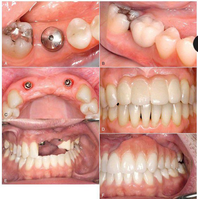 Implant treatment options - MEDizzy