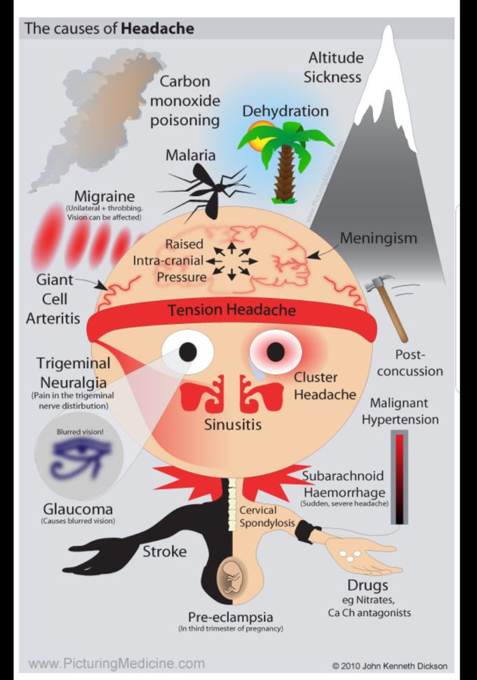 Headache causes - MEDizzy