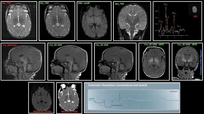 Quiet sequences @ Siemens 1.5T Aera Quiet sequences can be - MEDizzy