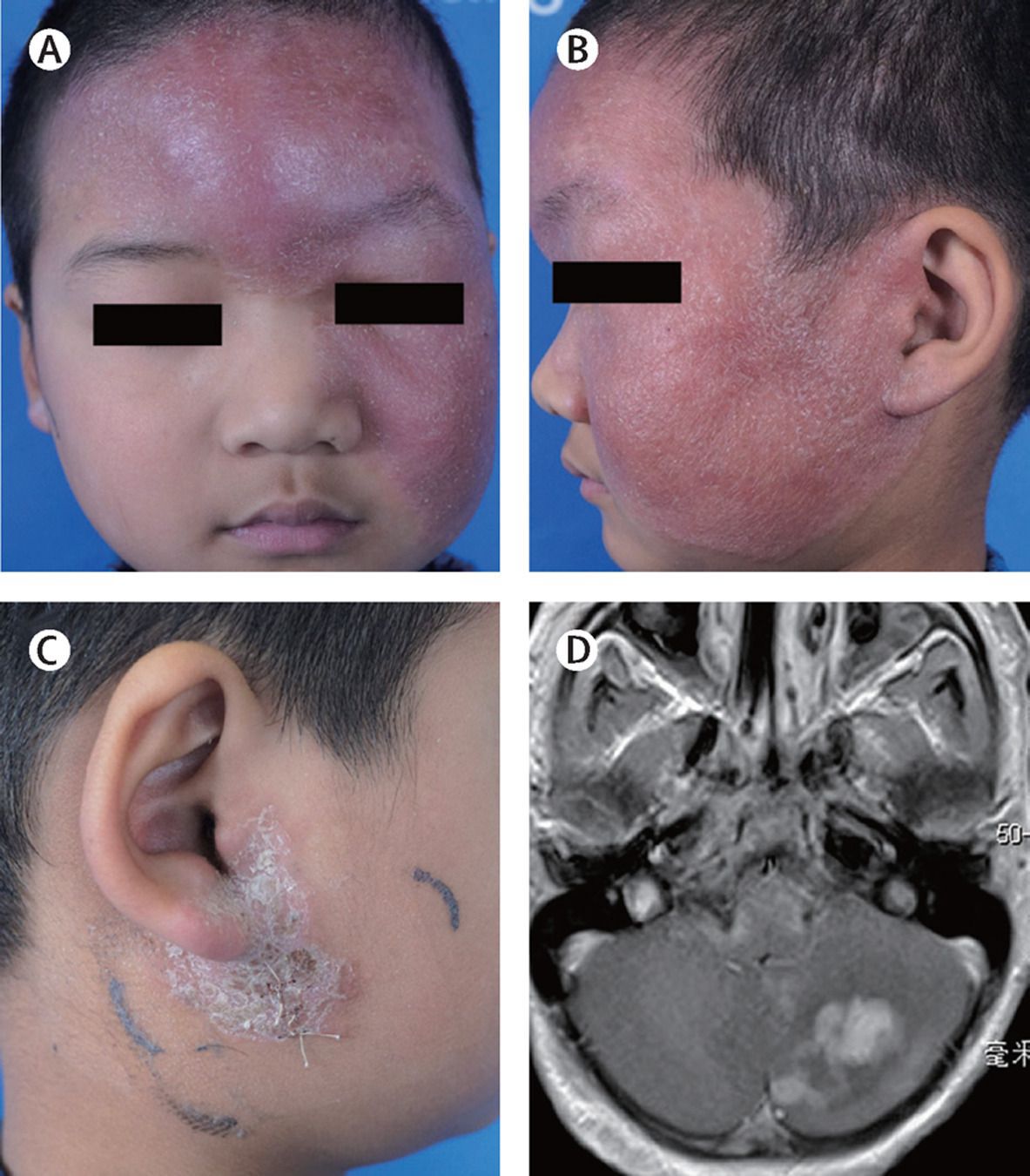 Symptoms Of Balamuthia Infection MEDizzy