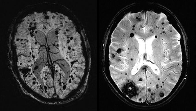 Cerebral Cavernous Malformations - MEDizzy