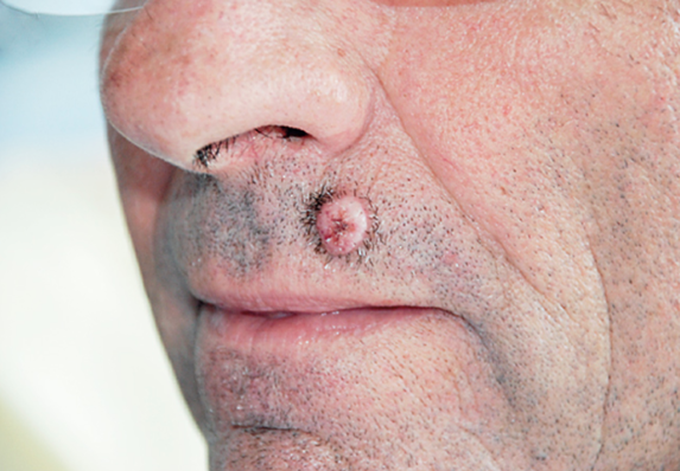 Skin lesion - MEDizzy