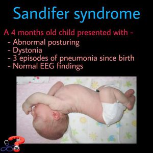 abnormal posturing in children