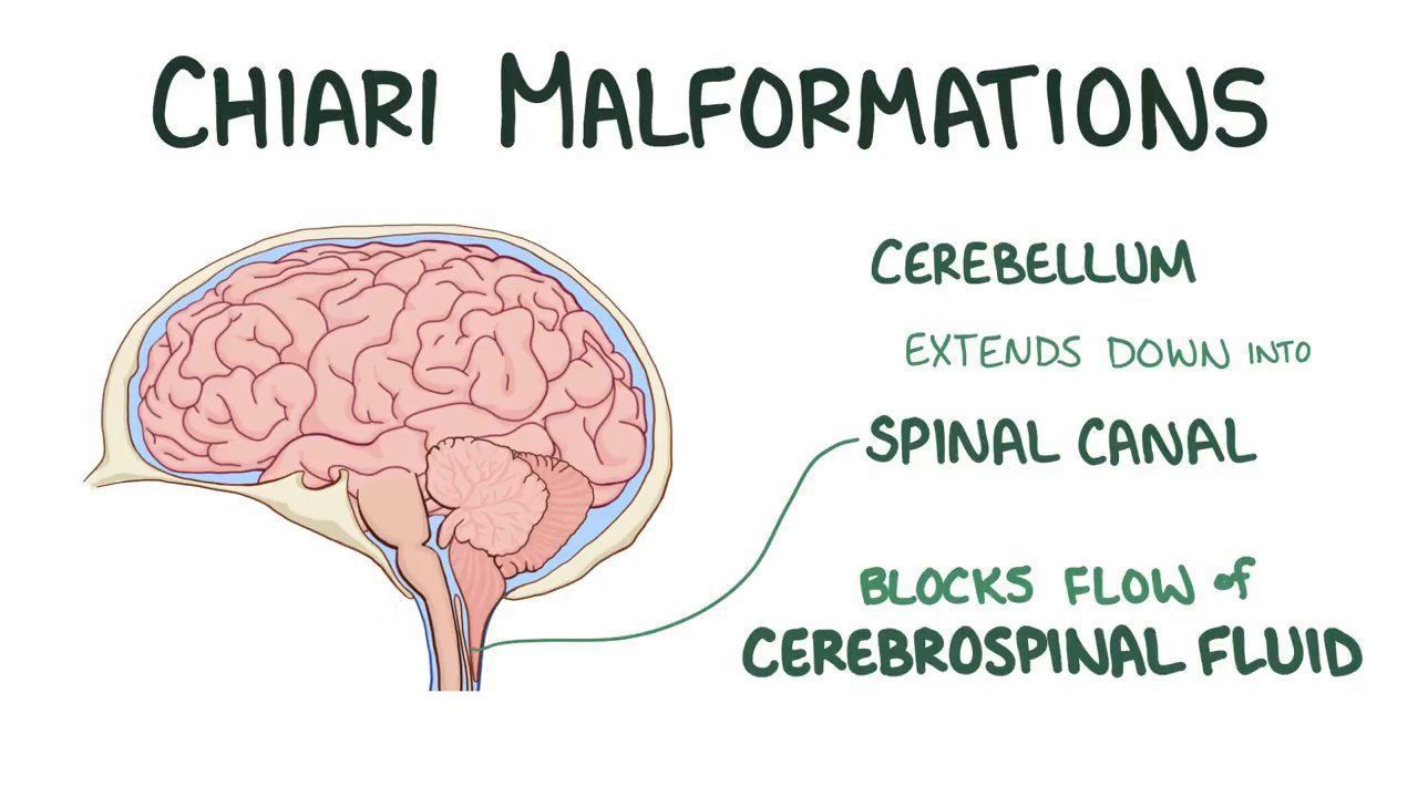 Arnold-Chiari malformation - MEDizzy