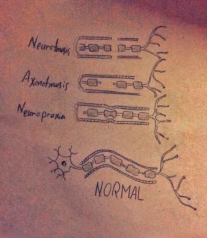Nerve damage - axonal injury - MEDizzy