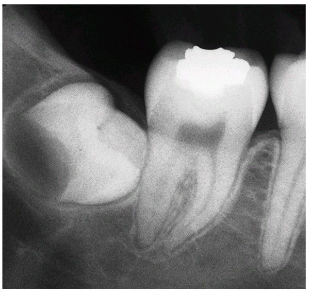 Impacted tooth contraindicated to be removed - MEDizzy