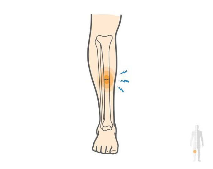 Hairline fracture - MEDizzy