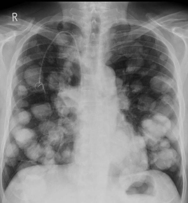 Chest xray - MEDizzy