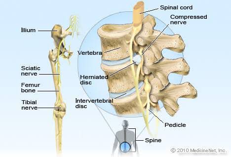 Slipped disc - MEDizzy