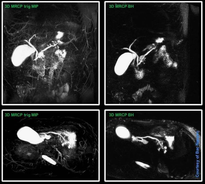 3D MRCP breath hold @ Siemens 1.5T Aera Highly optimized 3D - MEDizzy