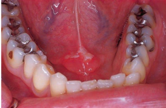 Ulcer On Floor Of Mouth Mouth Ulcer: Symptoms, Causes, And Treatment