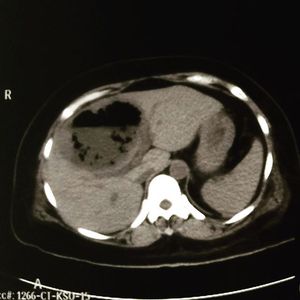 Hepatic abscess - MEDizzy
