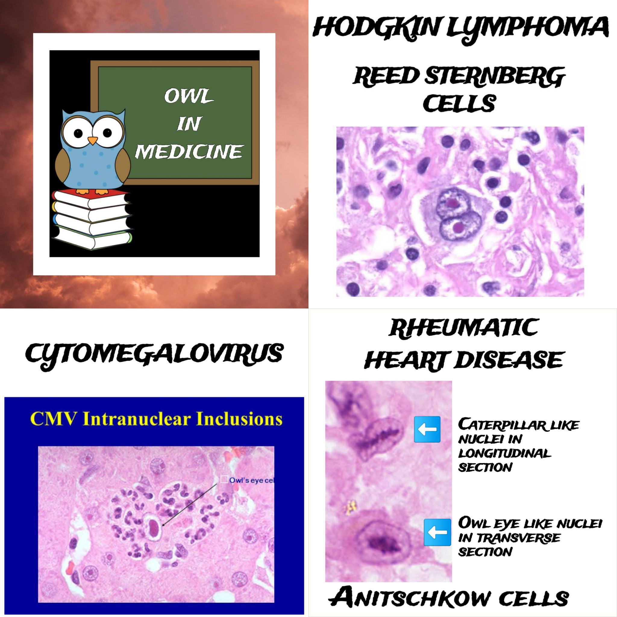 Reed Sternberg Cells Vs Cmv