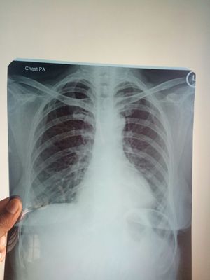 Chest xray - MEDizzy