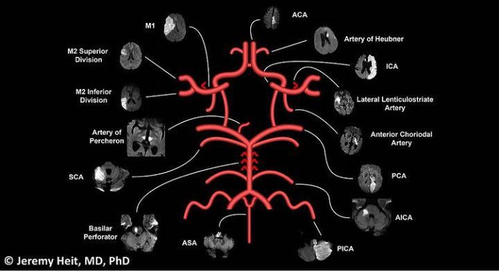 territories of brain stroke - MEDizzy