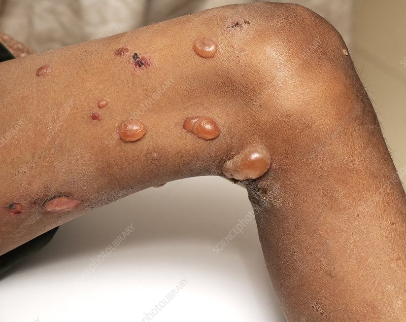 Pemphigus MEDizzy