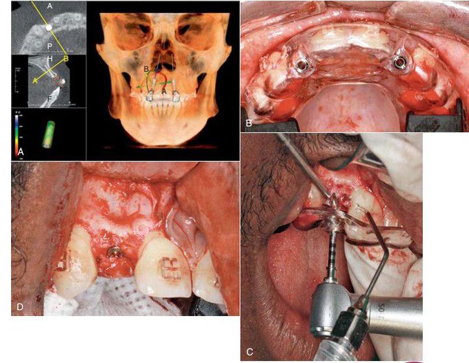 Anterior surgical guide. - MEDizzy