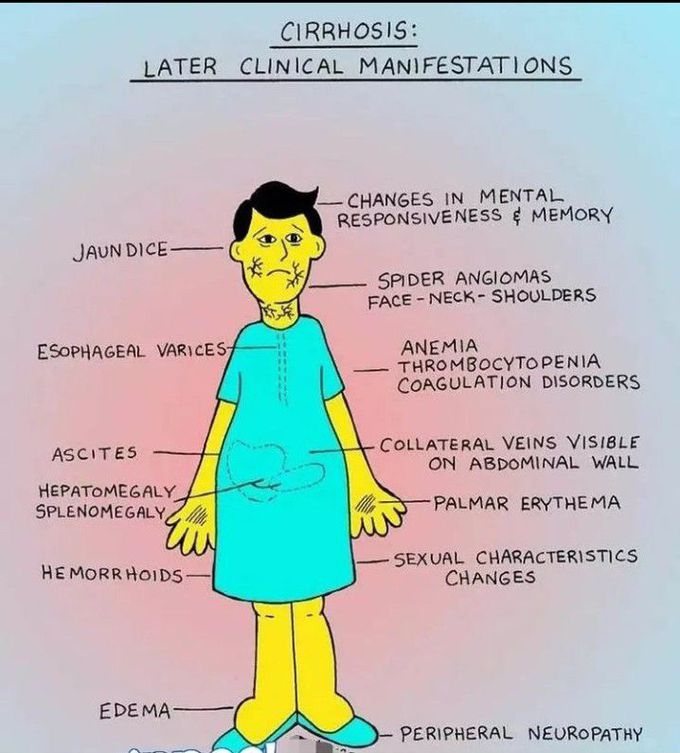 Cirrhosis clinical menifestation - MEDizzy
