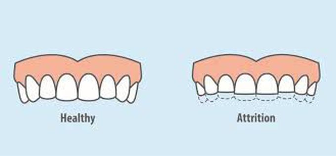 Dental attrition - MEDizzy