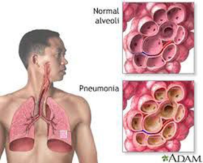 Symptoms of pneumonia - MEDizzy