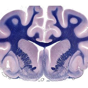 Transection of the cerebral hemispheres! - MEDizzy