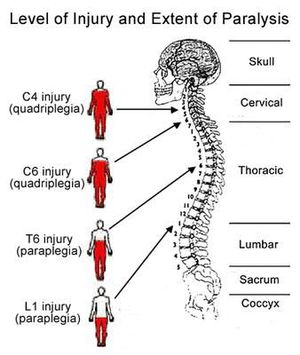 Level of injury and extend of paralysis - MEDizzy