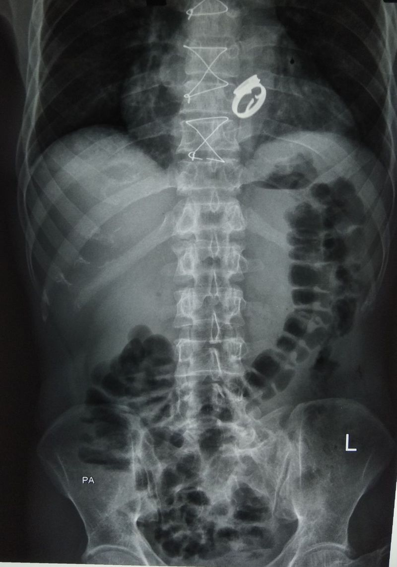 Valve replacement surgery - MEDizzy