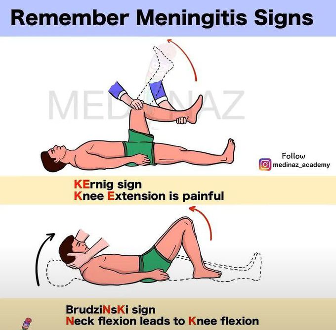 Signs of Meningitis-Mnemonic - MEDizzy