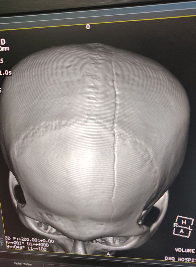 Skull Fracture - MEDizzy