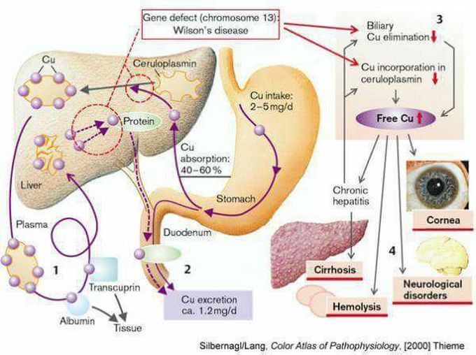 Wilson's diseases - MEDizzy