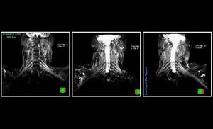Brachial Plexus @ Siemens 3T Skyra#Siemens_MRI #mri #plexus - MEDizzy