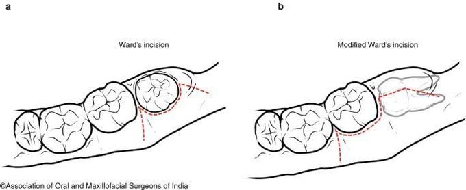 Wards Vs Modified Wards Incision - MEDizzy