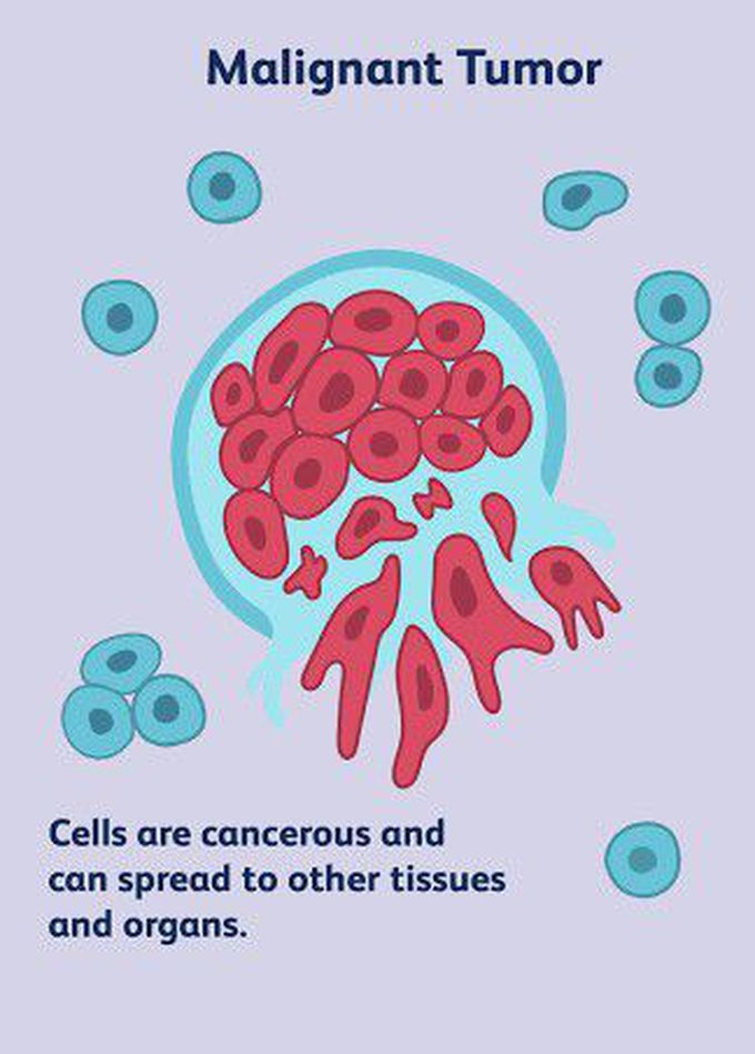 Malignant tumor - MEDizzy