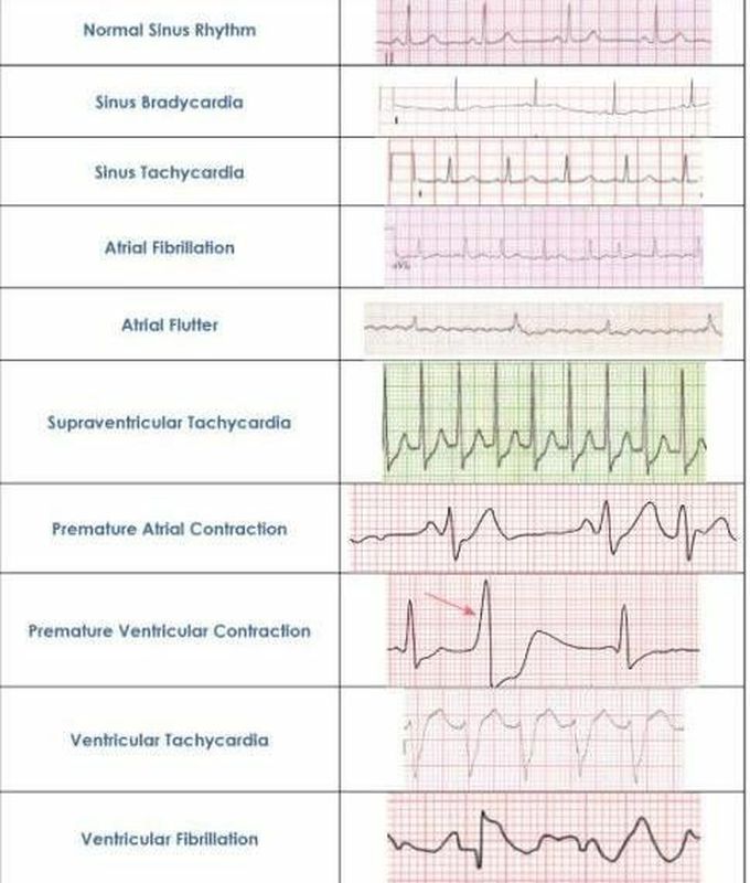 ECG learning - MEDizzy